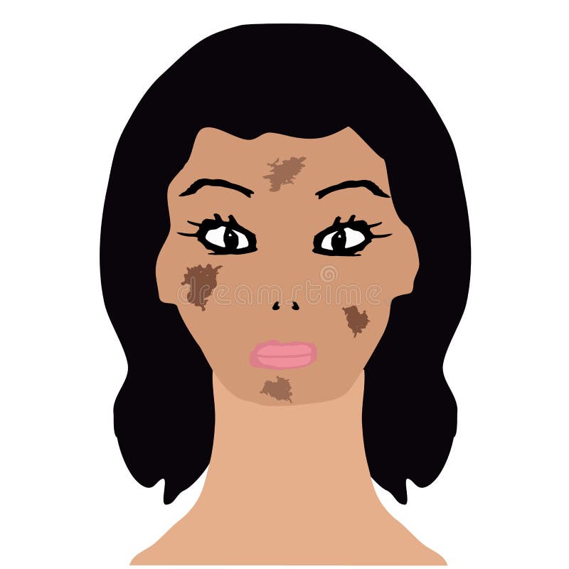 Woman Melasma Stock Illustrations – 56 Woman Melasma Stock ...