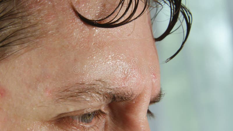 A Man with Sweating on His Face is Looking at the Camera. Sweat Gland ...