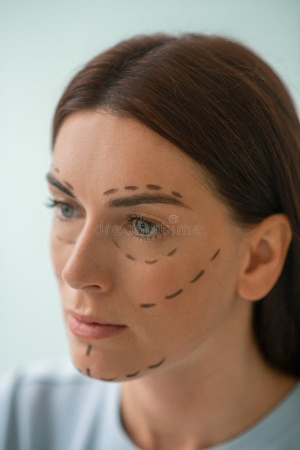 A Face of a Woman with Lines for Lifting Procedures Stock Photo - Image ...