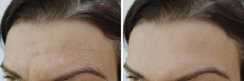 Face Wrinkles Forehead before and after Stock Photo - Image of filler ...