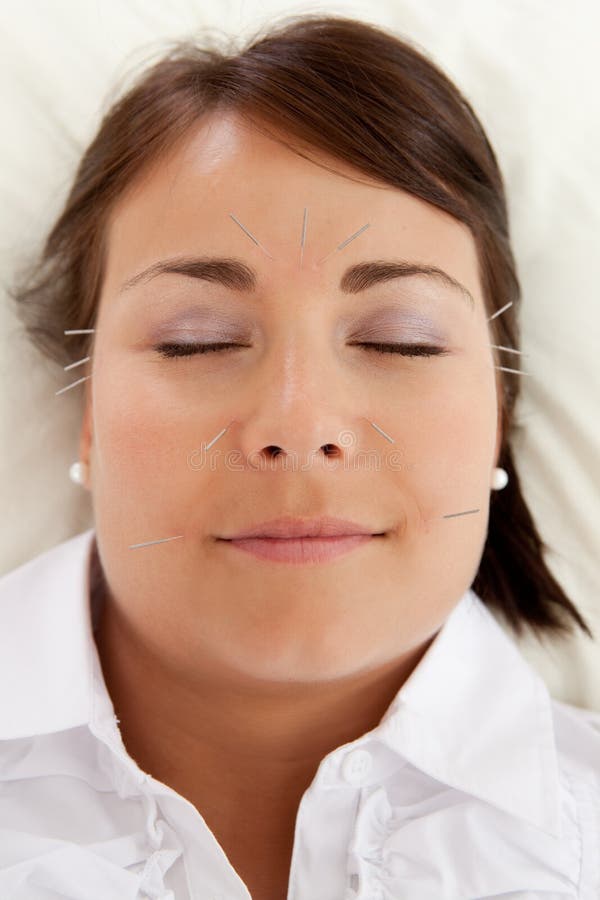 Facial Beauty Acupuncture Treatment Stock Image - Image of care ...