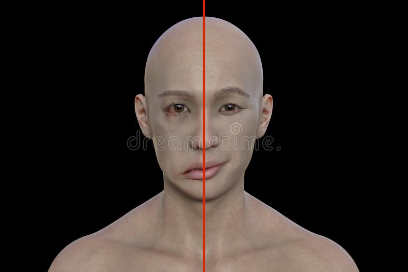 Facial Palsy in a Man, 3D Illustration Highlighting the Asymmetry and ... Facial Palsy in a Man, 3D Illustration Highlighting the Asymmetry and ...