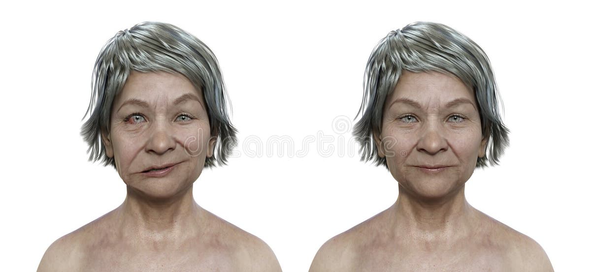 Facial Drooping Stock Illustrations – 99 Facial Drooping Stock ... Facial Drooping Stock Illustrations – 99 Facial Drooping Stock ...