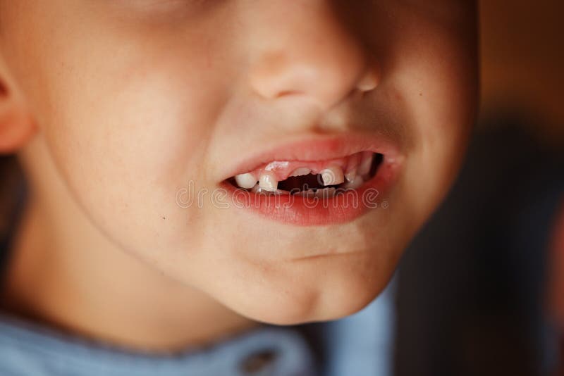 Fall Out of the Kids First Tooth. Stock Image - Image of hygiene ...
