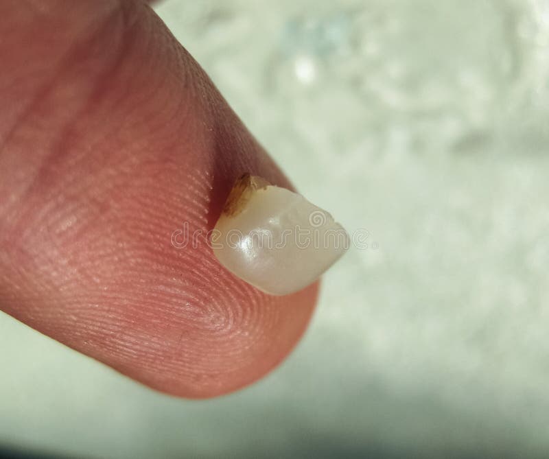 Fallen Off Old Filling with a . the Seal of the Tooth Stock Image ...