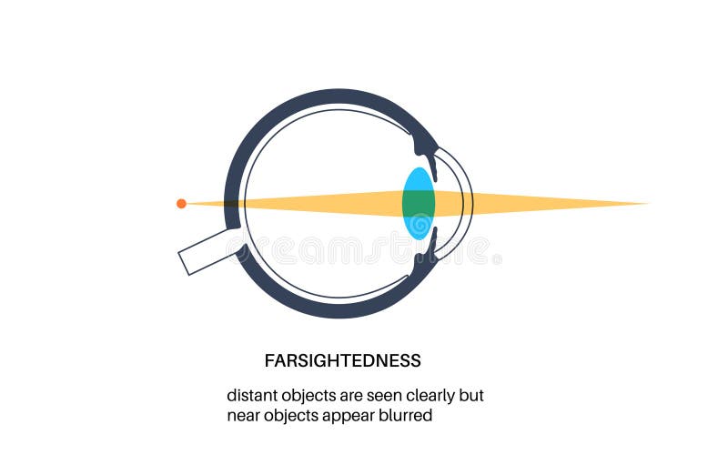 Farsightedness eye disease stock vector. Illustration of vision - 302443889