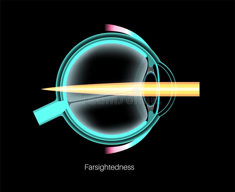 Farsightedness eye disease stock illustration. Illustration of ...