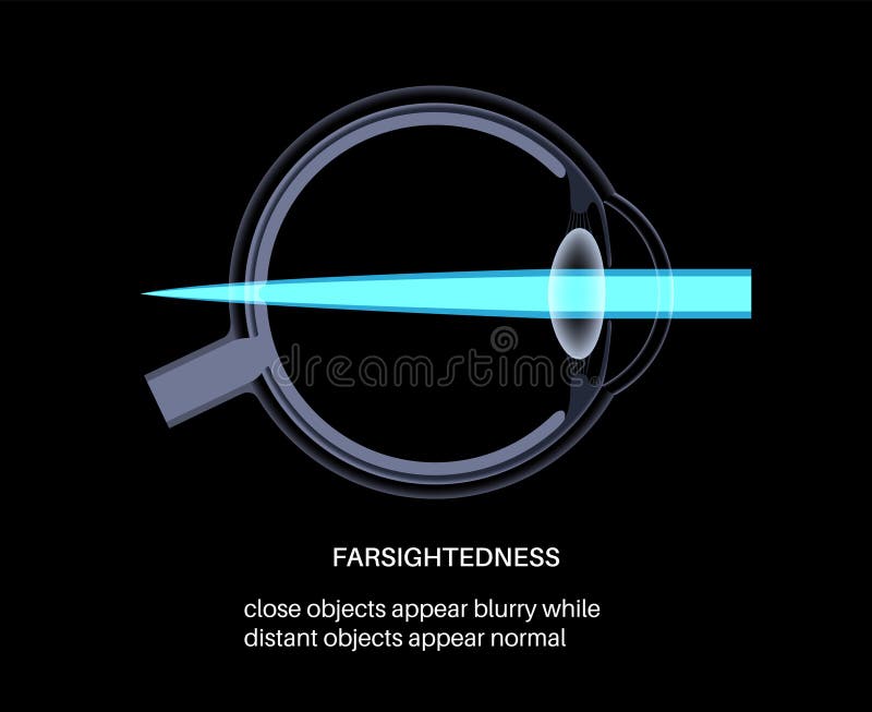 Farsightedness eye disease stock vector. Illustration of optic - 354013407