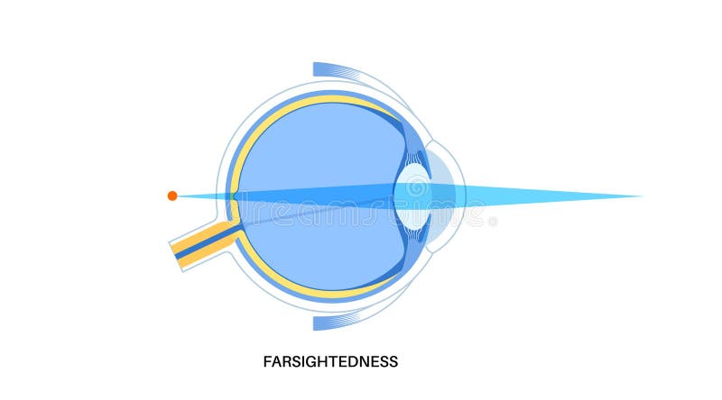 Farsightedness eye disease stock vector. Illustration of nerve - 302325759