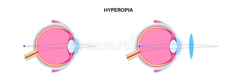 Normal Eye and Farsightedness Stock Vector - Illustration of system ...