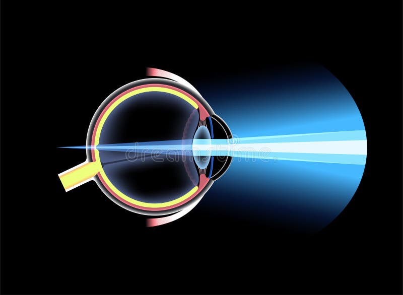 Farsightedness eye disease stock vector. Illustration of eyeball ...