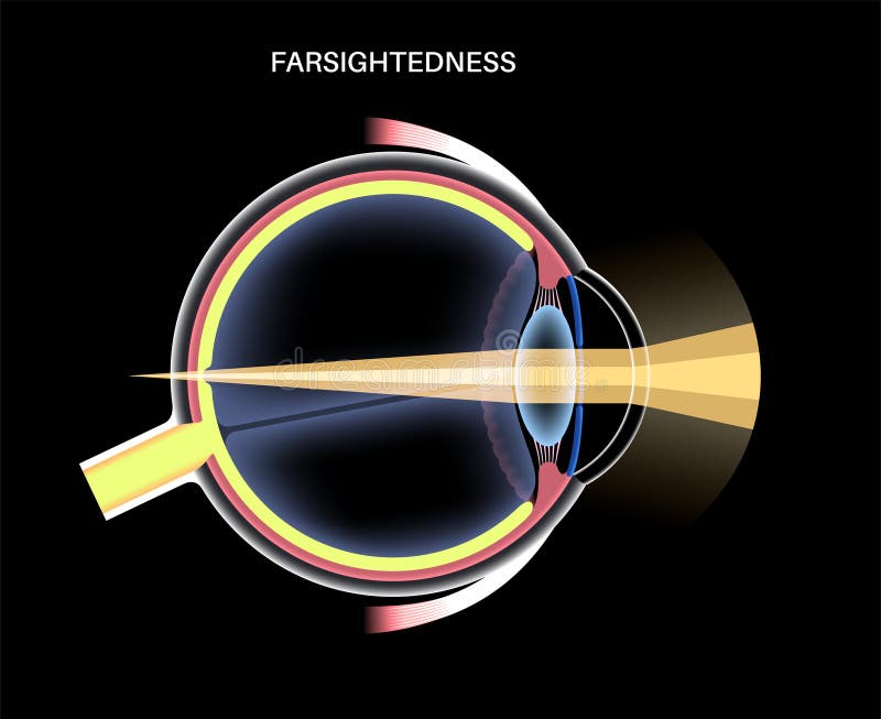 Farsightedness eye disease stock vector. Illustration of ocular - 354632753