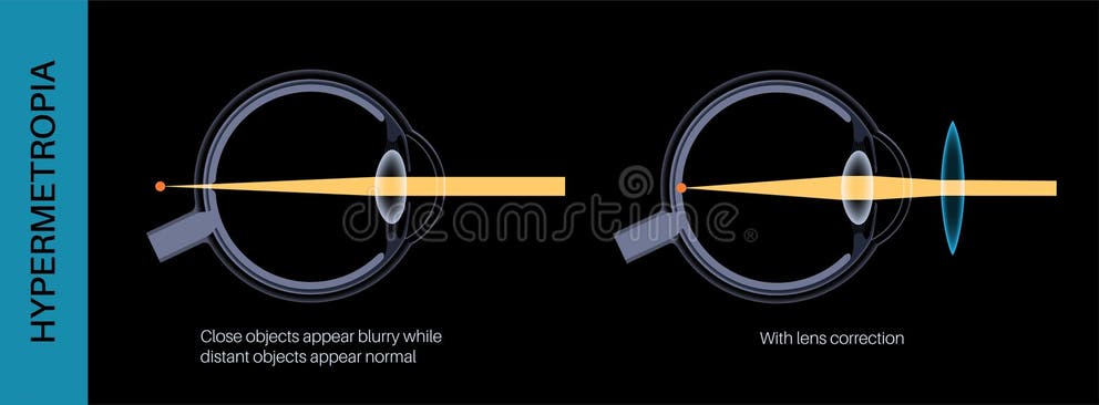 Farsightedness Lens Correction Stock Vector - Illustration of macula ...