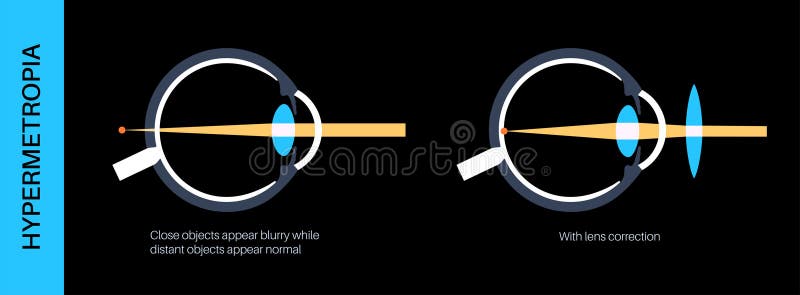 Farsightedness Lens Correction Stock Illustration - Illustration of ...