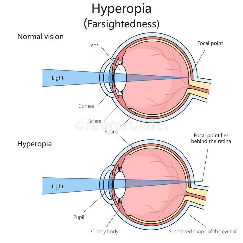 Farsightedness Structure Diagram Medical Science Stock Vector ...