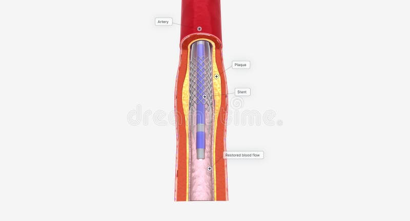 Fat Layer Accumulating in Arteries Stock Illustration - Illustration of ...