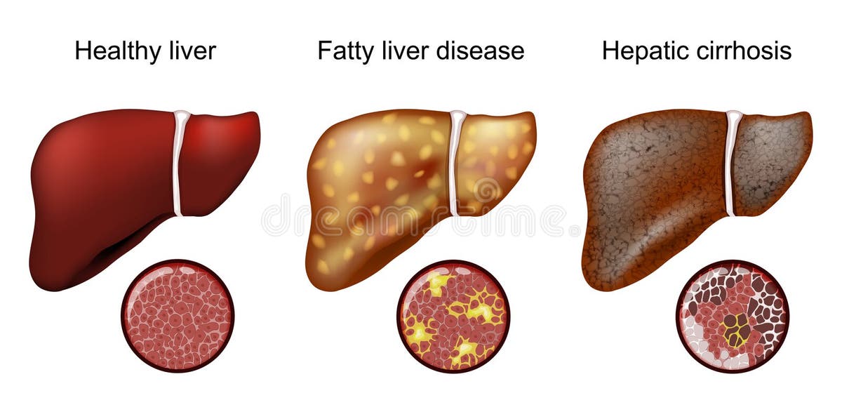Normal Hepatocytes Stock Illustrations 51 Normal Hepatocytes Stock Illustrations Vectors