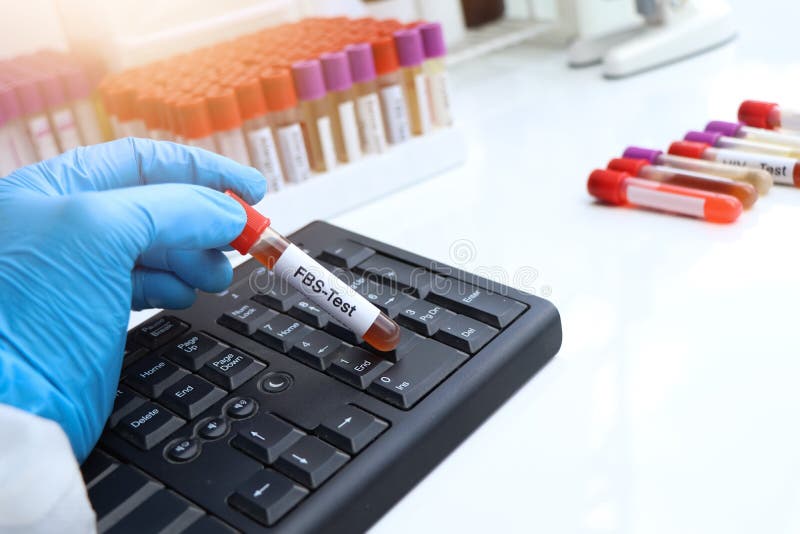FBS Test To Look for Abnormalities from Blood Stock Photo - Image of ...
