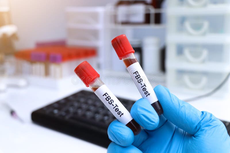 FBS Test To Look for Abnormalities from Blood Stock Photo - Image of ...