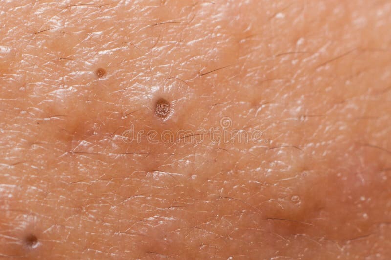 Fechado-acima Das Pústulas Da Espinha No Nariz Foto de Stock - Imagem ...