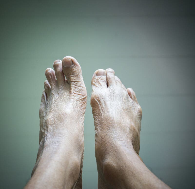 Feet Bare Pose of an Older Person Stock Photo - Image of injury, human ...