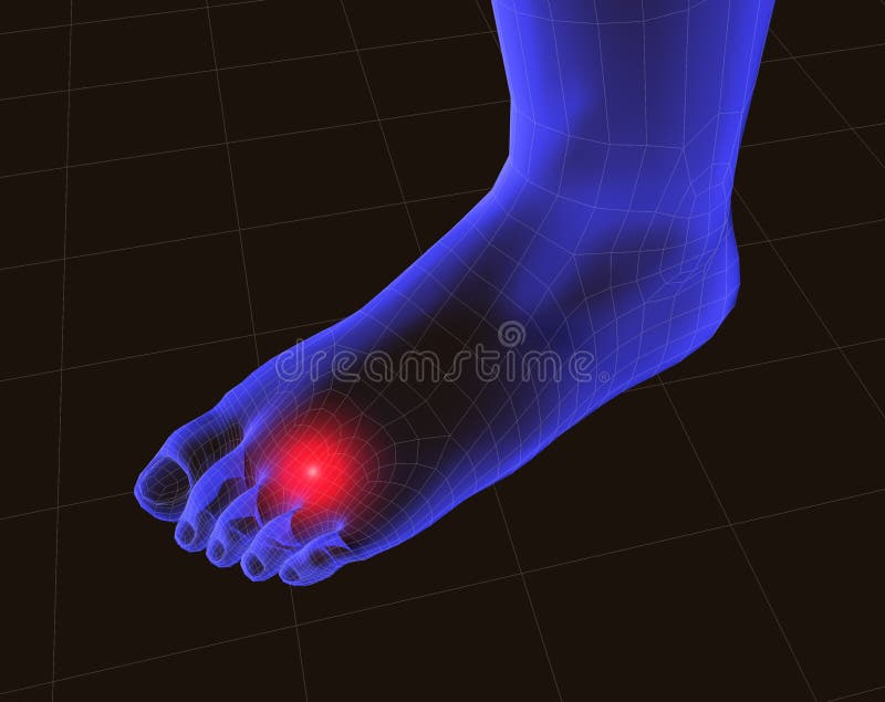 Foot and pain stock illustration. Illustration of diagnosis - 14559843
