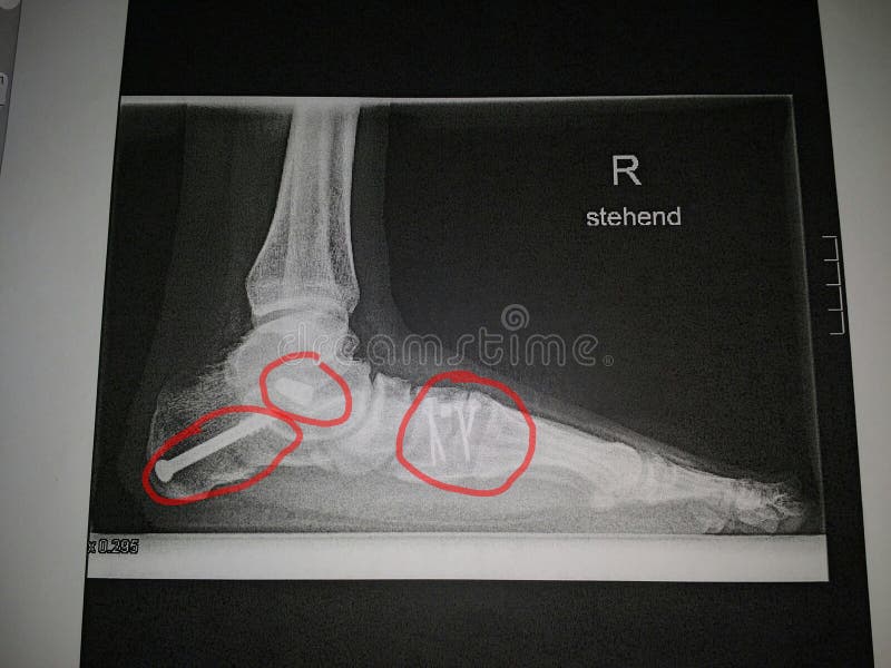 Feet stock image. Image of operation, feet, surgery, rehabilitation ...