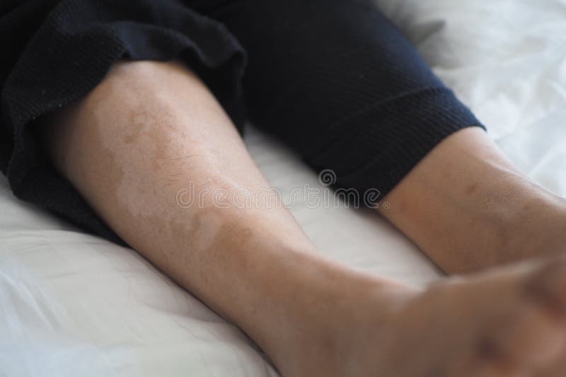 Feet with Vitiligo Skin Condition. Stock Photo - Image of condition ...