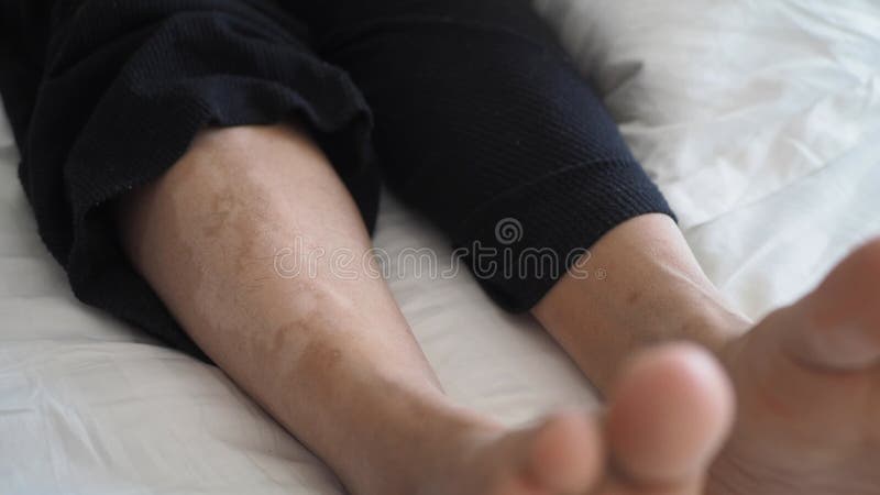 Feet with Vitiligo Skin Condition. Stock Video - Video of condition ...