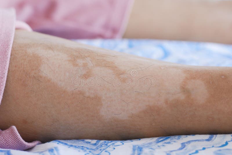 Feet with Vitiligo Skin Condition. Stock Photo - Image of limb, knee ...