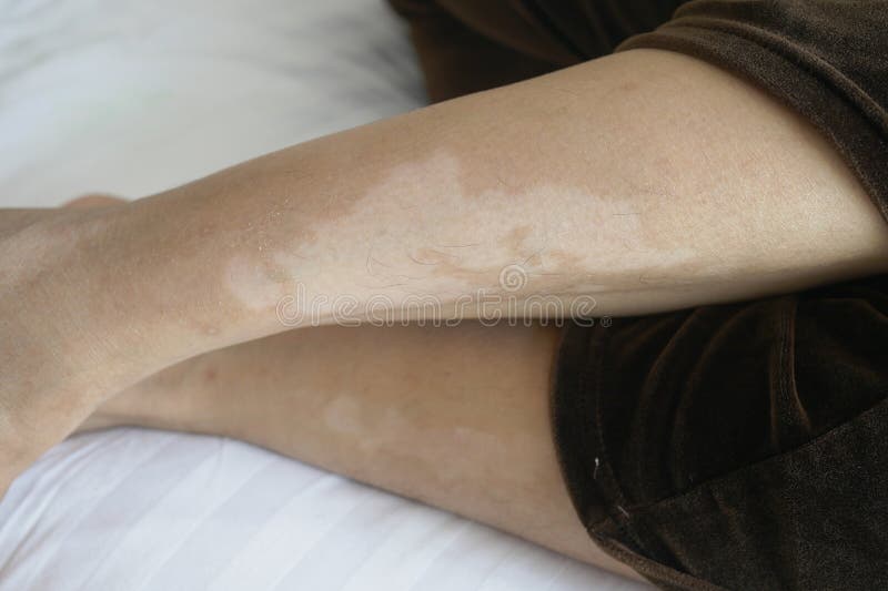 Feet with Vitiligo Skin Condition. Stock Photo - Image of autoimmune ...