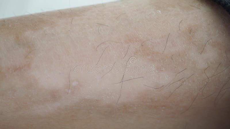 Feet with Vitiligo Skin Condition. Stock Footage - Video of disorder ...