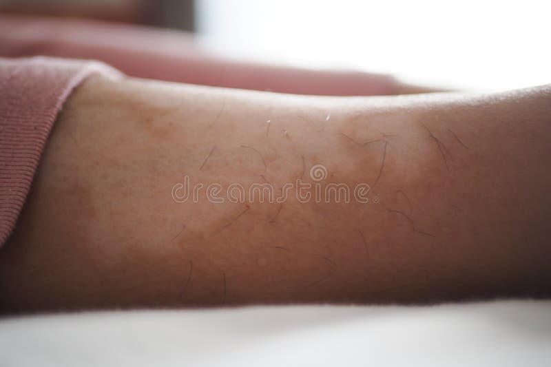 Feet with Vitiligo Skin Condition. Stock Image - Image of chronic, skin ...