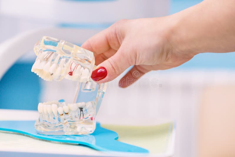 Female Dentist Opening Teeth Model with Cavities Stock Image - Image of ...
