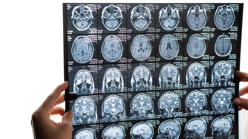A Female Doctor Examines an MRI Scan of the Brain. Stock Photo - Image ...