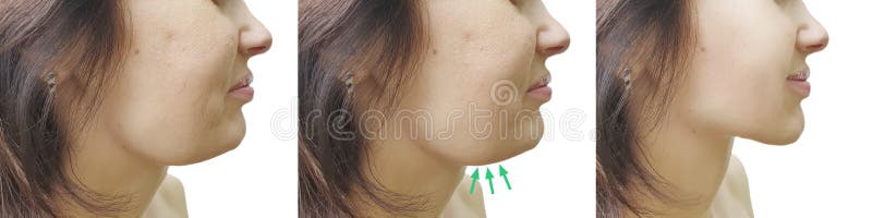 Female Double Chin before and after Correction Stock Image - Image of ...