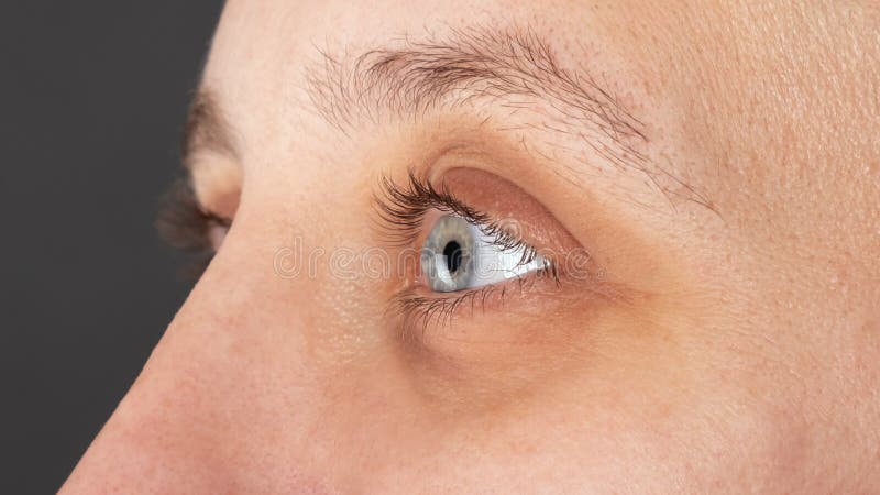 Female Eye Diagnosed with Keratoconus,corneal Dystrophy Stock Photo ...