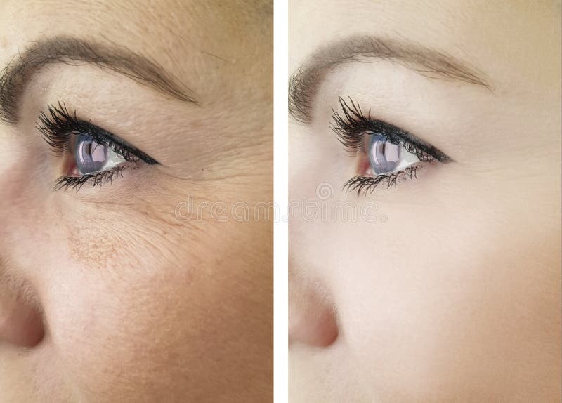 Female Eye Wrinkles Aging before Removal after Lift Effect Difference ...