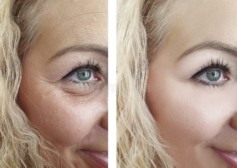 Female Eye Wrinkles before and after Effect Difference Correction ...
