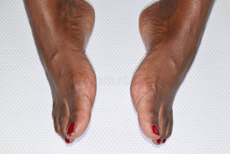 Female feet turned inward stock photo. Image of turned - 82379604