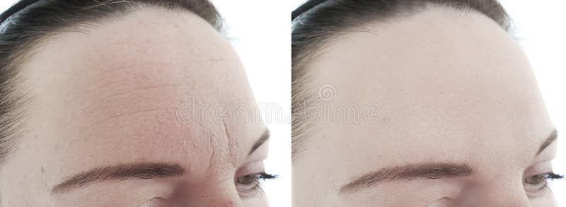 Female Forehead Wrinkles before and after Correction Procedures Stock ...