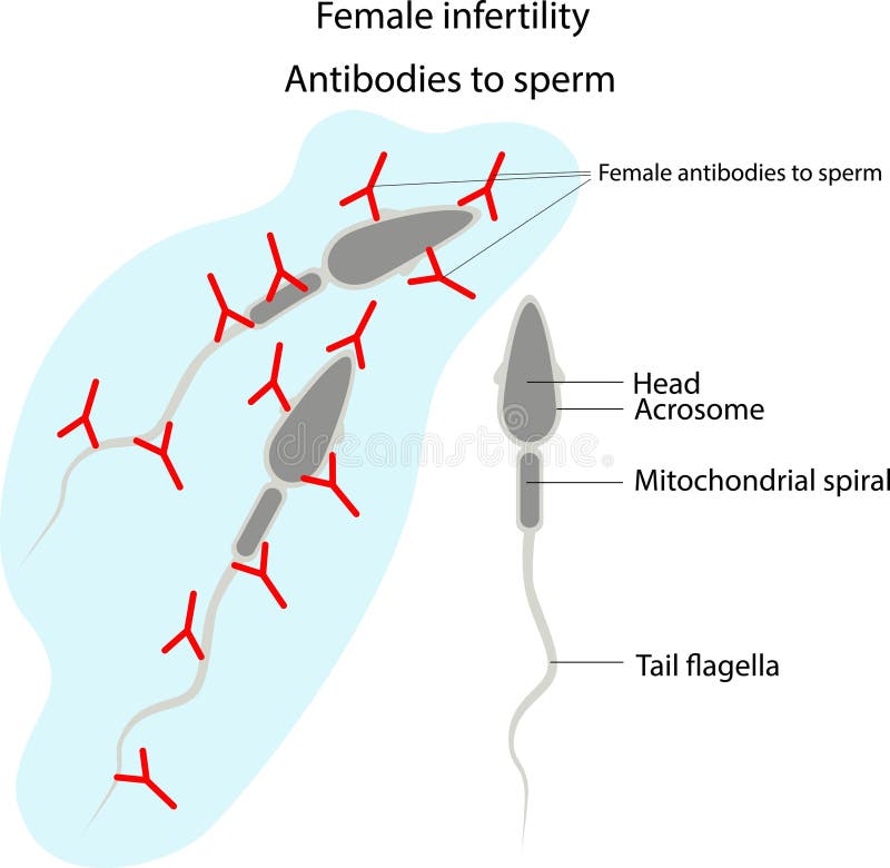 Female Infertility. the Structure of the Sperm. Stock Vector ...