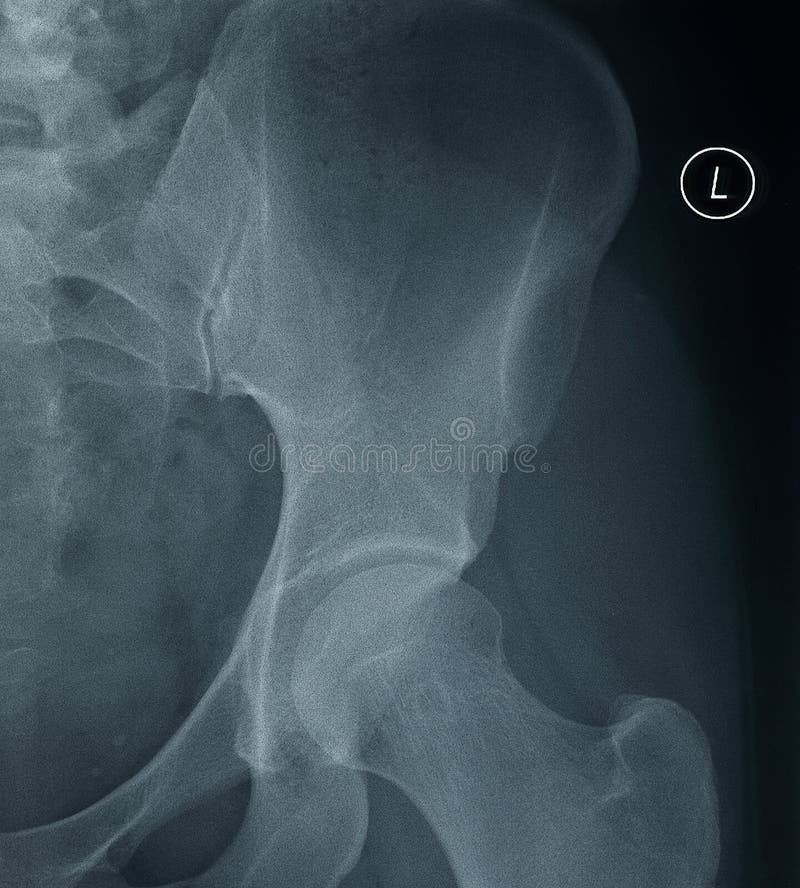 Female Left Hip X-Ray stock photo. Image of medicine - 72038664