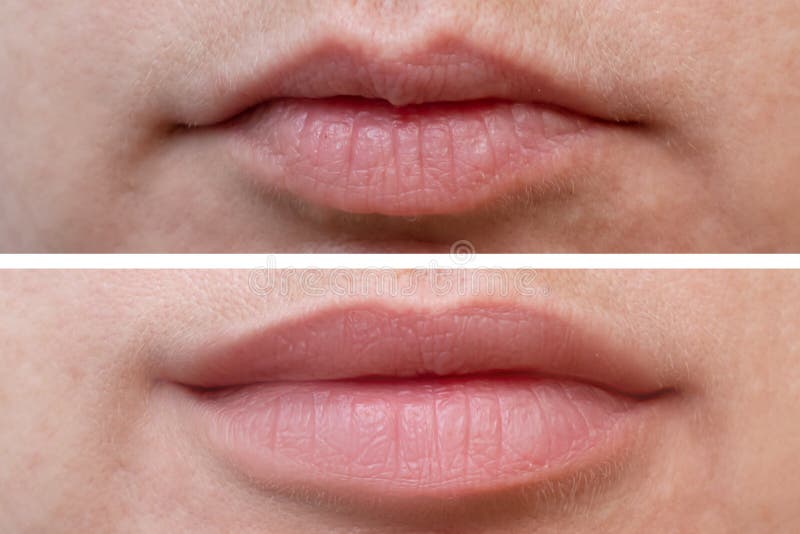 Before and after Female Lip Filler Injections. Fillers Stock Photo ...