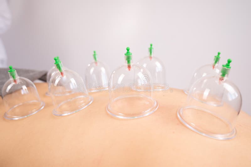 Female Massage Therapist Uses Vacuum Cans on the Patient S Back. Stock ...