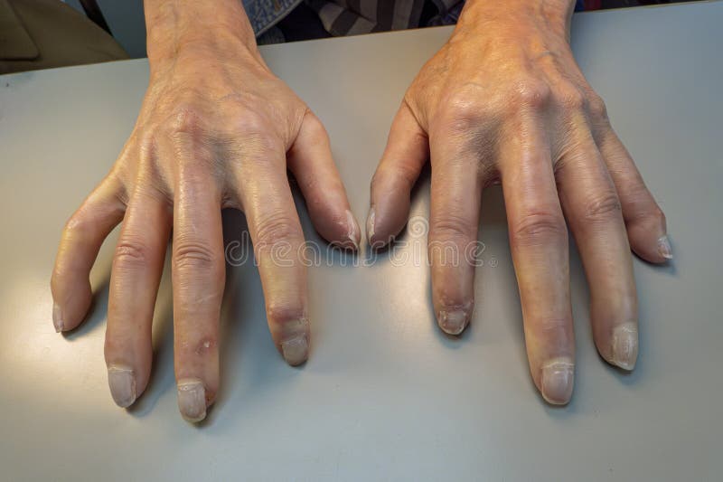 Female Patient Hands with Scleroderma Stock Image - Image of illness ...