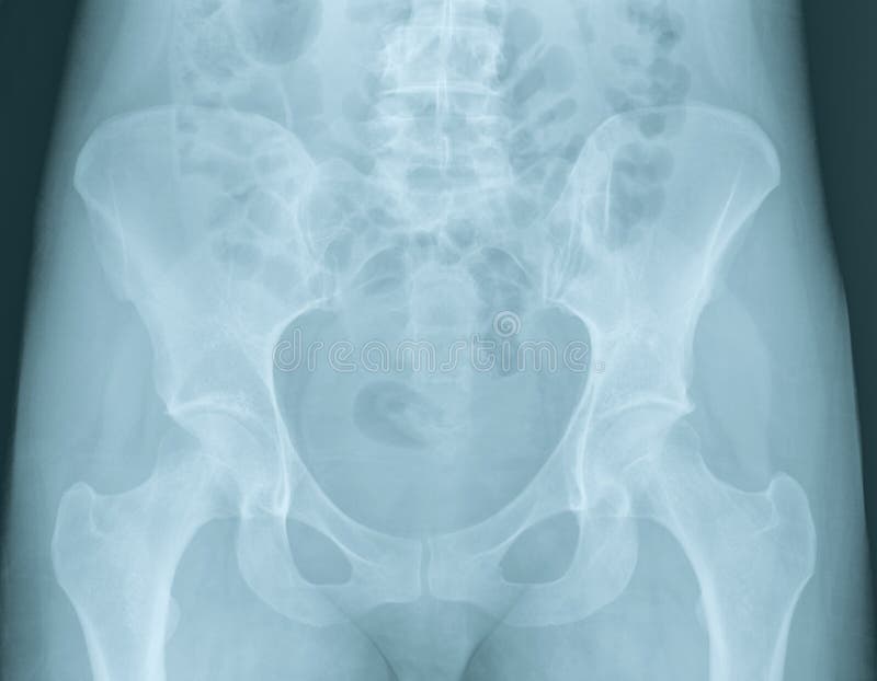 Female Pelvis X-Ray stock photo. Image of medicine, injury - 7064298