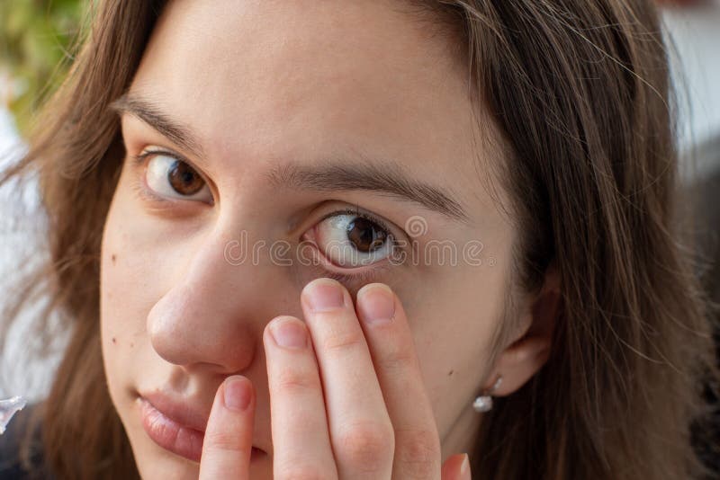 Female Red Eye after a Long Work at the Computer, Study. Problems with ...