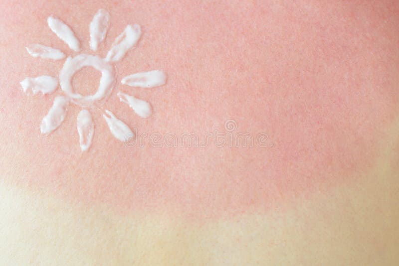 Female Skin with Red Burn after Sunburn on the Beach Stock Photo ...