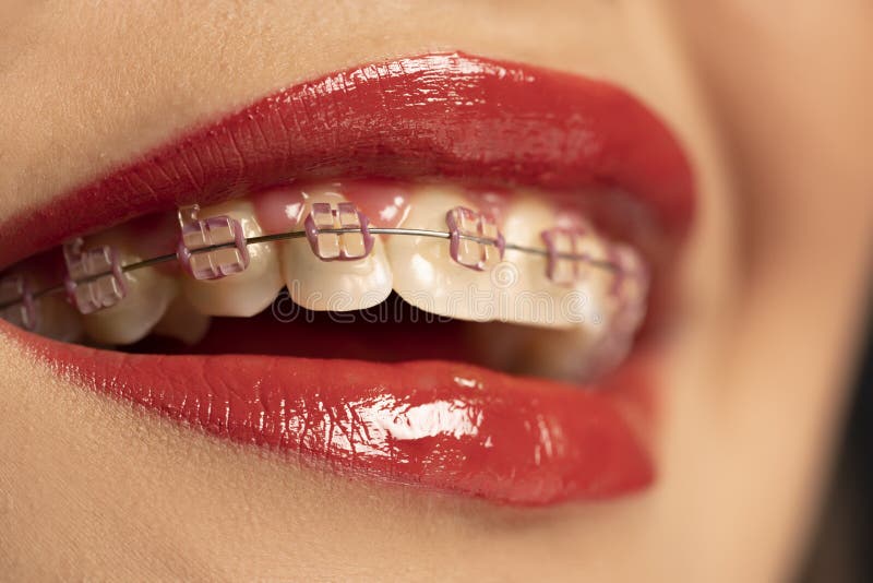 Female Smiling Mouth with Braces Stock Image - Image of dental, metal ...